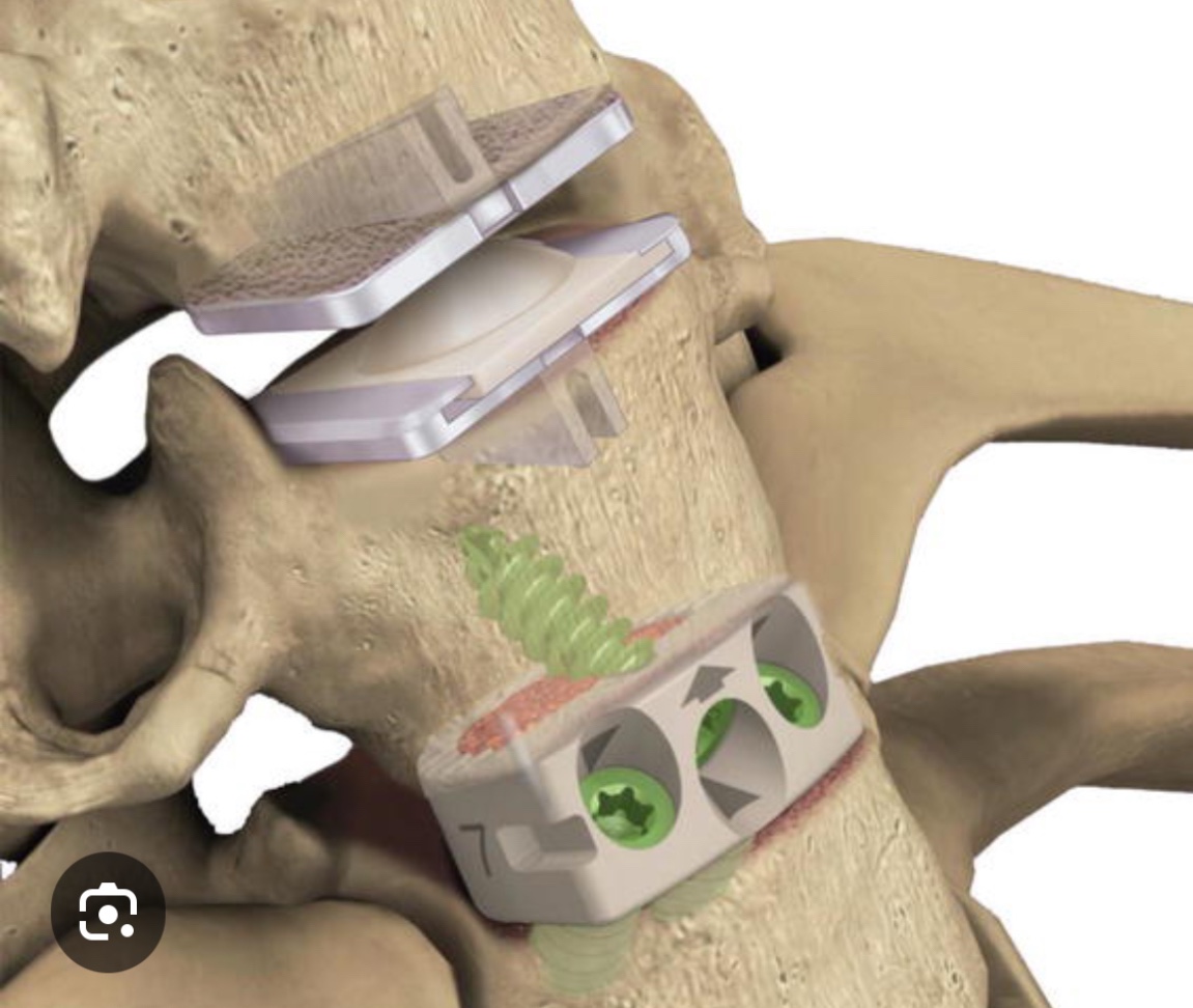 Hybrid Disc Replacement Fusion Surgery - Better Disc Replacement